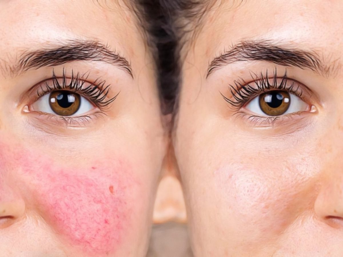 Comment rendre les veines du visage moins visibles ? - Aram Clinique ...